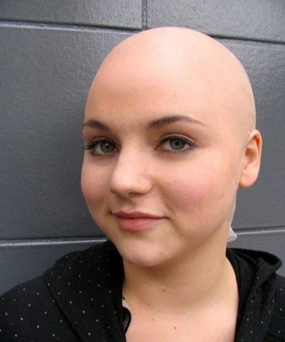 What is the difference between Alopecia Universalis and Alopecia ...